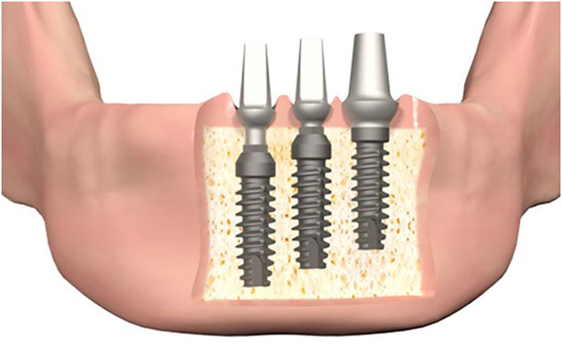 Quantum Implants | Implants